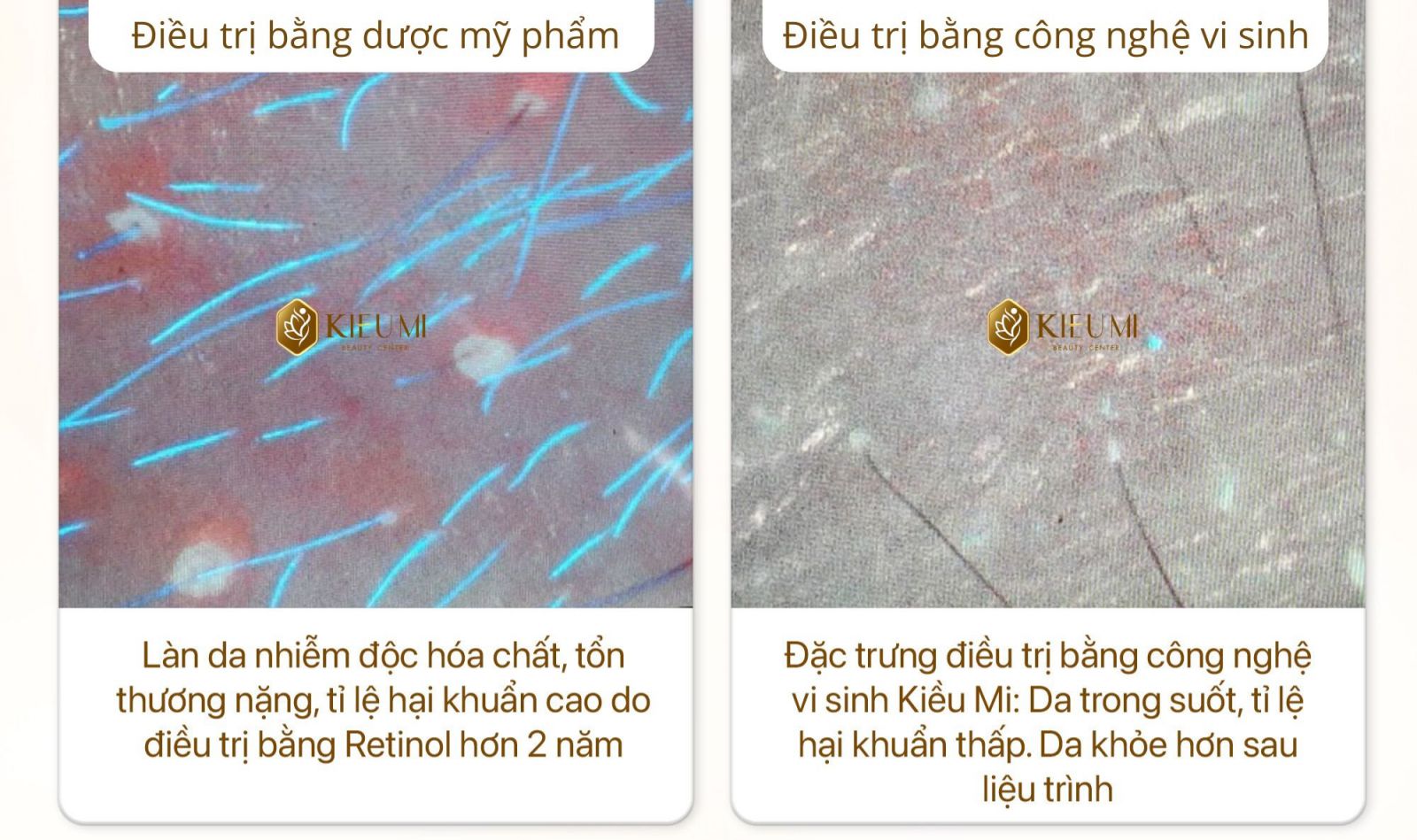 Khám Phá Nguyên Nhân & Phương Pháp Trị Mụn Từ Gốc Tại Kiều Mi Beauty